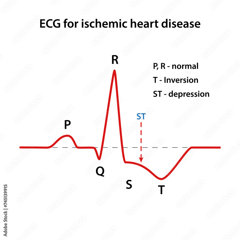 Diagram of the ECG for coronary heart disease. Heart cardiogram. Vector ...