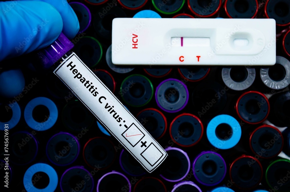 Blood sample of patient negative tested for hepatitis C virus by rapid ...