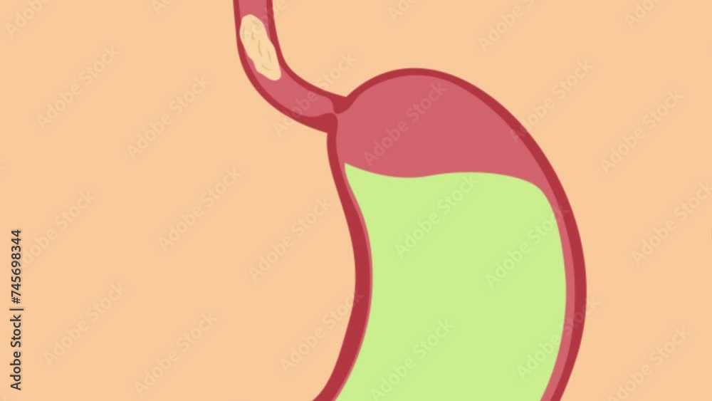 Vidéo Stock Stomach Acid Relux. Esophagus, gerd. Pain In The Digestive ...
