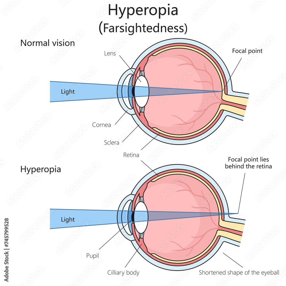 Farsightedness hypermetropia hyperopia structure diagram hand drawn ...