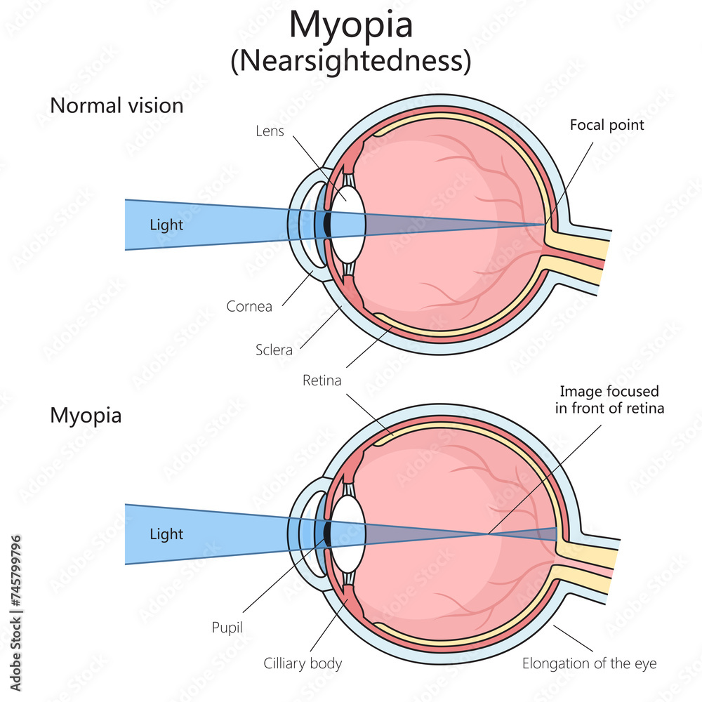 Myopia disorder of vision structure diagram hand drawn schematic raster illustration. Medical ...
