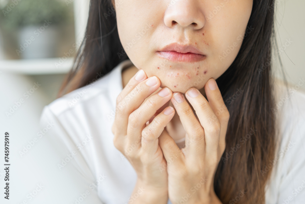 Expression worry asian young woman looking at mirror touching pustule ...