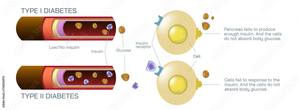 Difference between type one diabetes and type two diabetes. Where body ...
