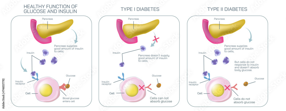Difference between type one diabetes and type two diabetes. Where body ...