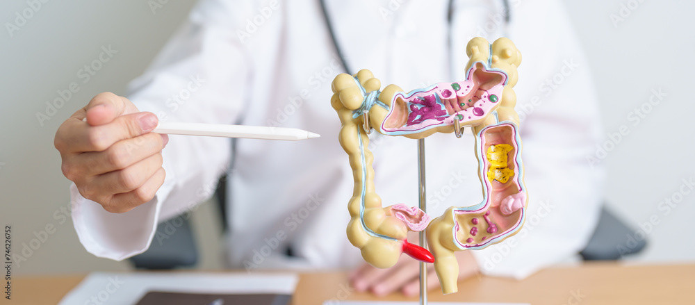 Doctor with human Colon anatomy model. Colonic disease, Large Intestine ...