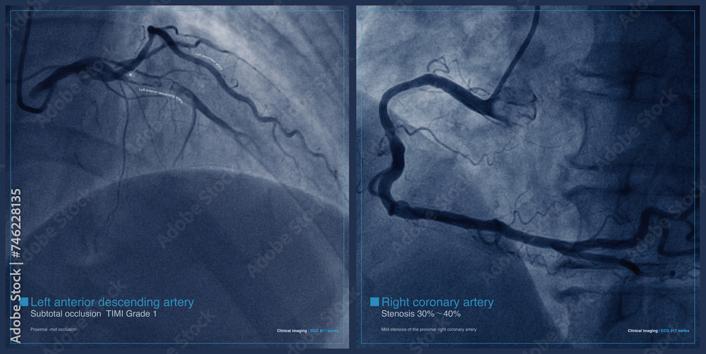 Male, 65 years old, admitted with chest pain for 2 hours. Coronary ...