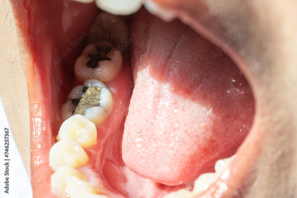 ooth's a woman smoking bad. woman smokes a cigarettes have tooth decay ...