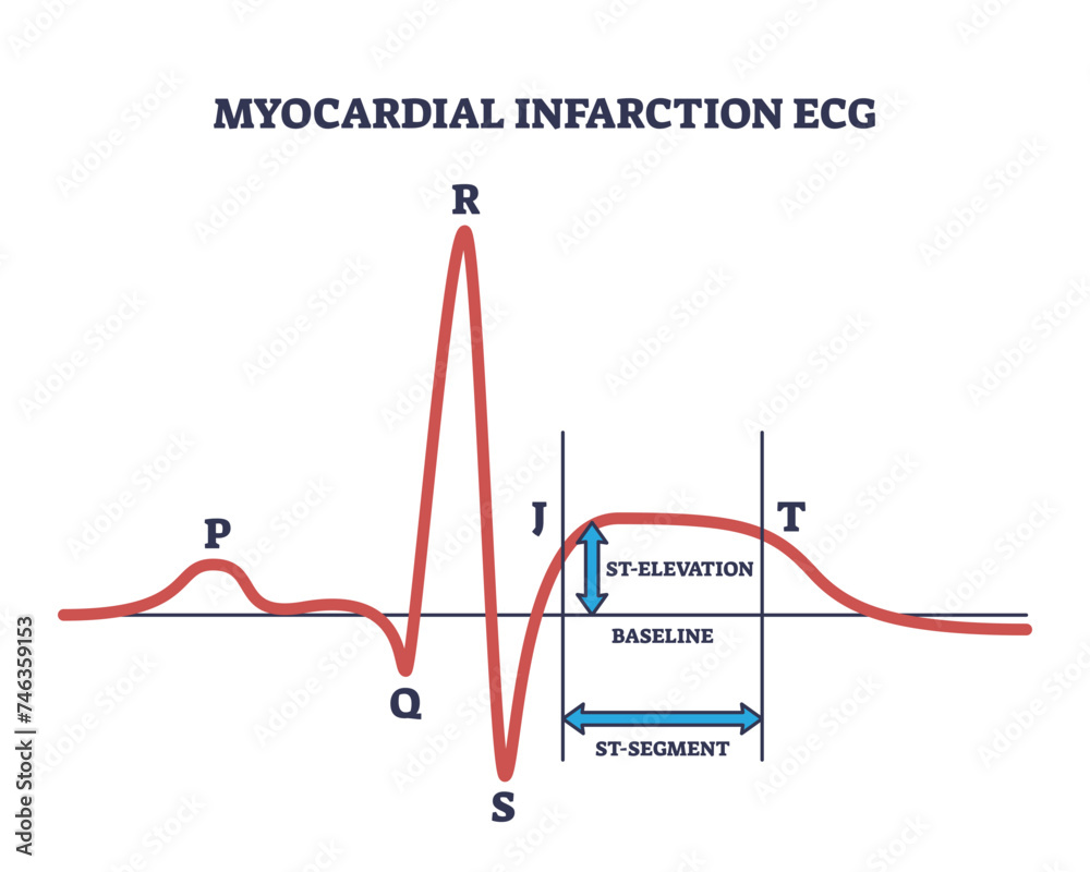 Myocardial infraction ECG with abnormal ST segment elevation outline ...