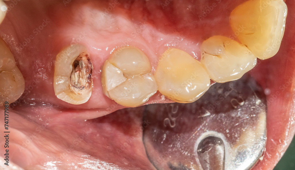 Maxillary arch with decayed premolar crown half destroyed, remaining ...