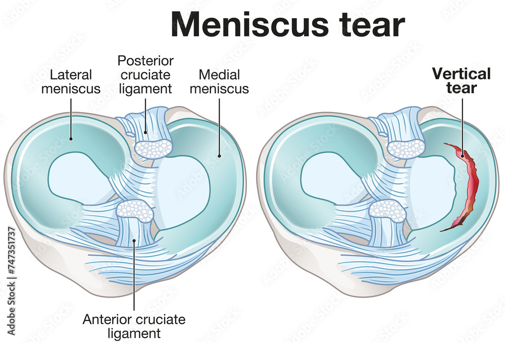 Meniscus tear. Labeled illustration Stock Illustration | Adobe Stock