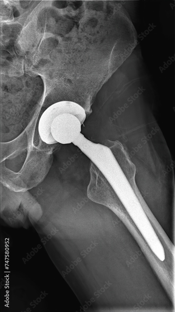 X-ray photo of left hip prosthesis. Lateral view. 12 weeks after total ...