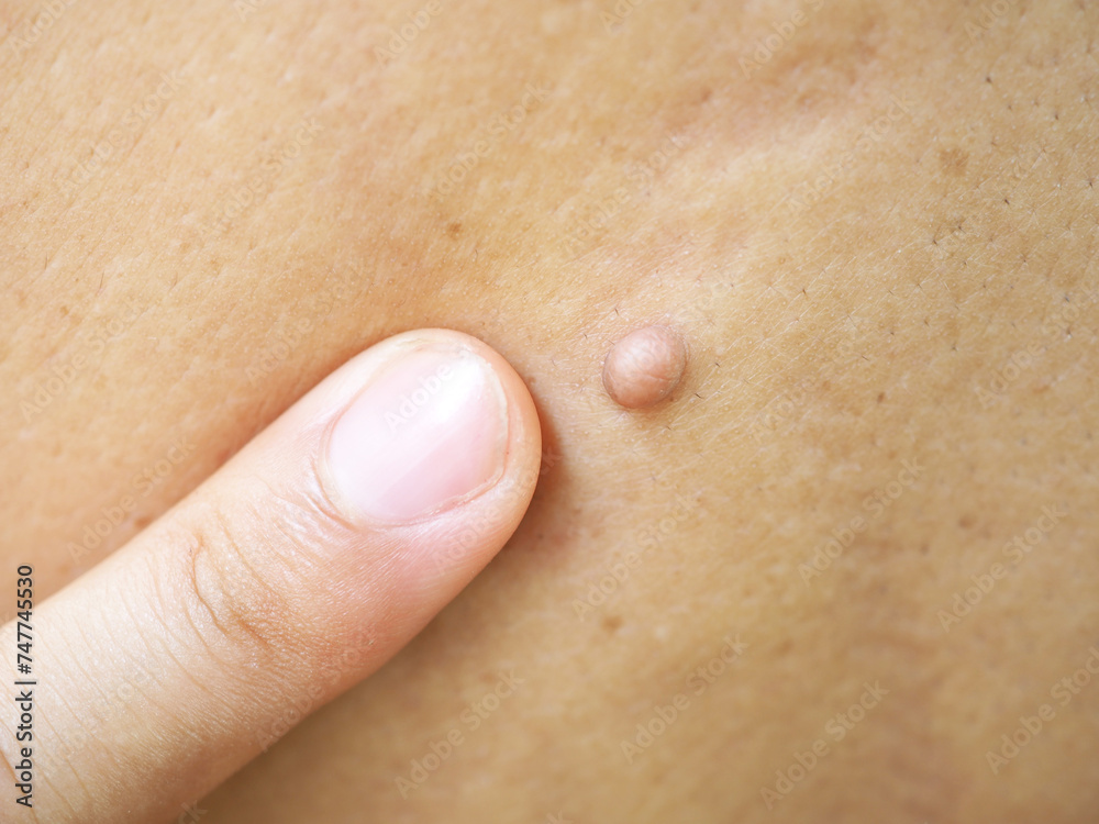 Pink mole on back asian man of skin lesion case of proliferation of ...