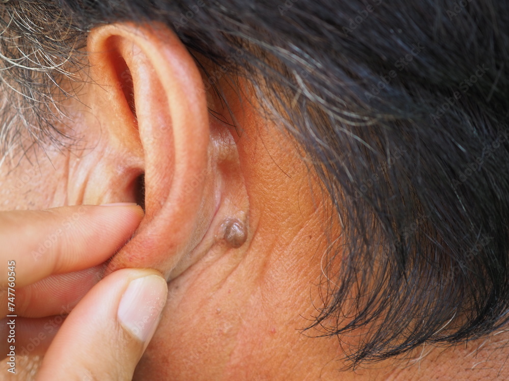 Sebaceous cysts on his neck, formed by sebaceous glands. Oils called ...