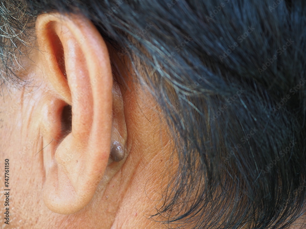 Sebaceous cysts on his neck, formed by sebaceous glands. Oils called ...