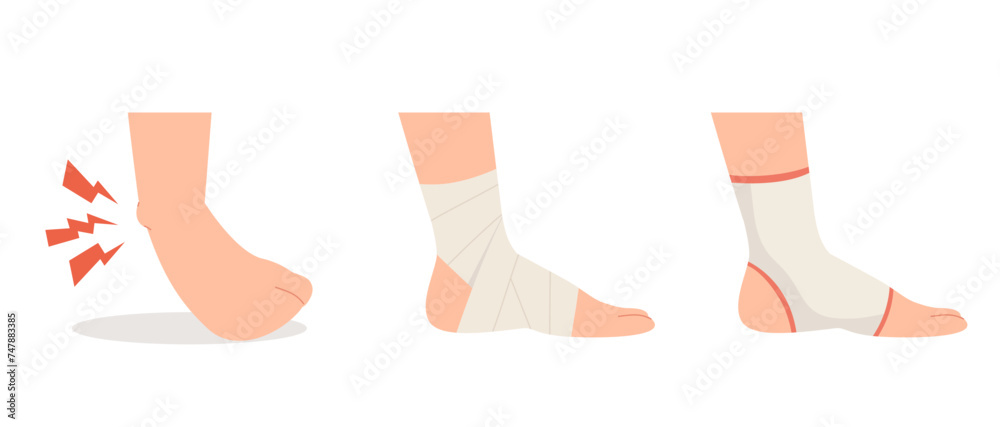 Sprained ankle foot with elastic bandage and ankle support treatments ...