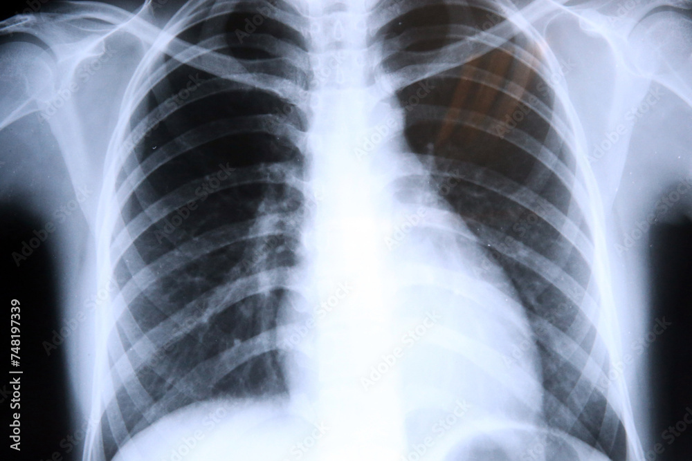 Lungs Radiography. X-rays. Stock Photo | Adobe Stock