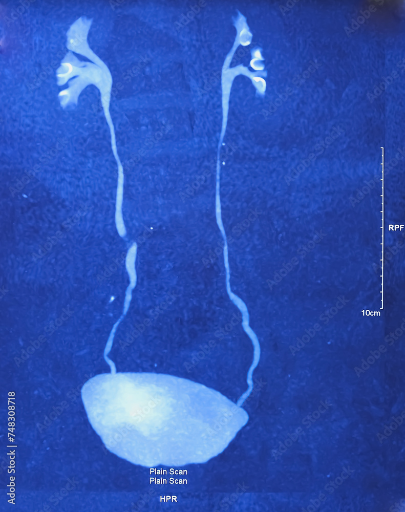 CT (computerized tomography) Urogram, used to evaluate the urinary ...