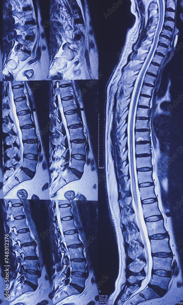 MRI (magnetic resonance imaging) of Lumbo sacral Spine. L4-L5 and L5-S1 ...