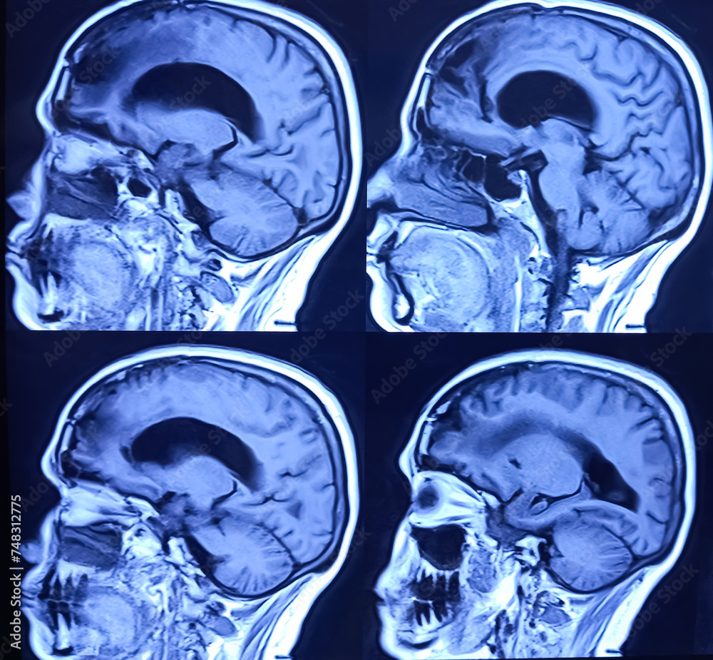 CT scan of PNS and Head: Hypertrophied both inferior nasal turbinates ...