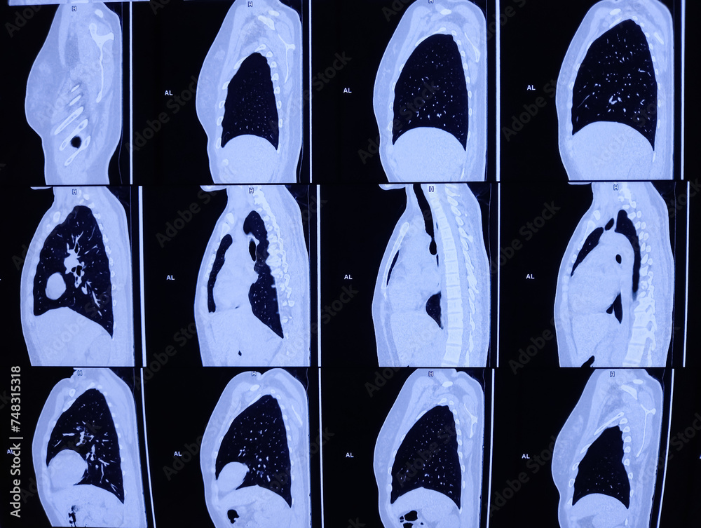 Multi slice HRCT scan of chest showing normal study, normal appearance ...