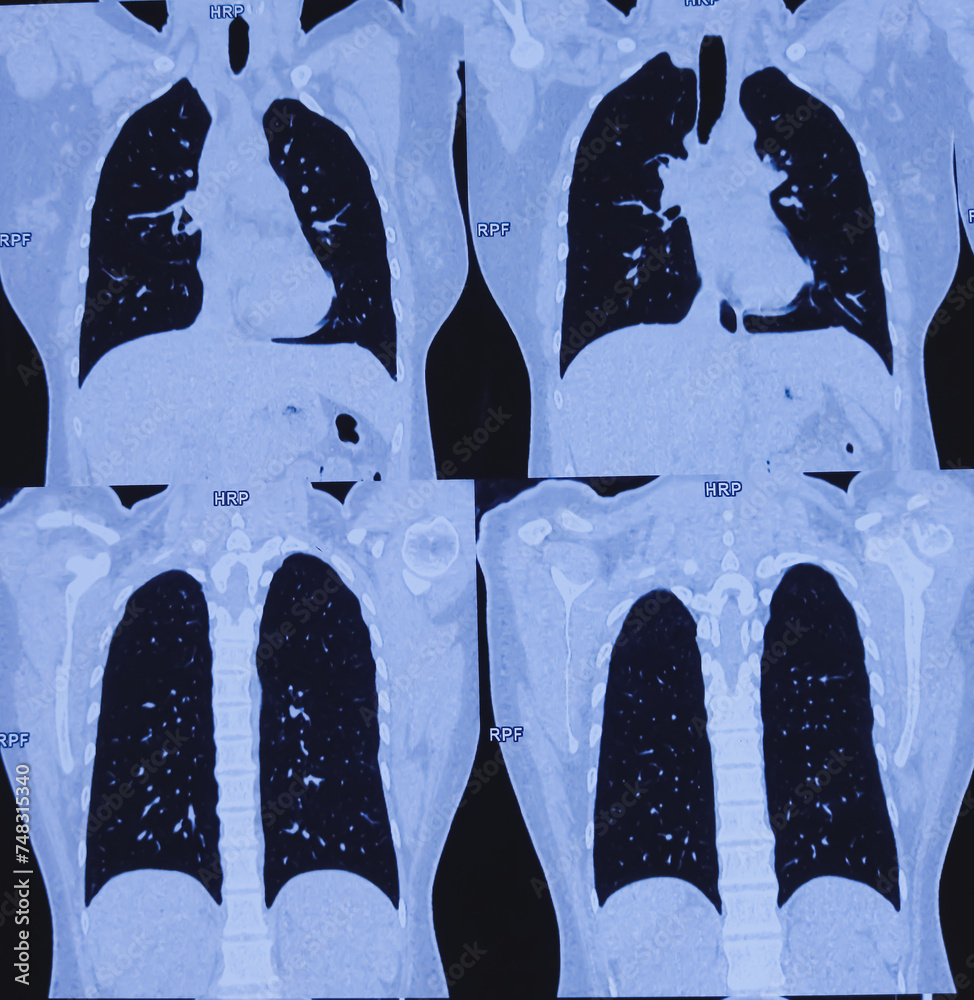 Multi slice HRCT scan of chest showing normal study, normal appearance ...