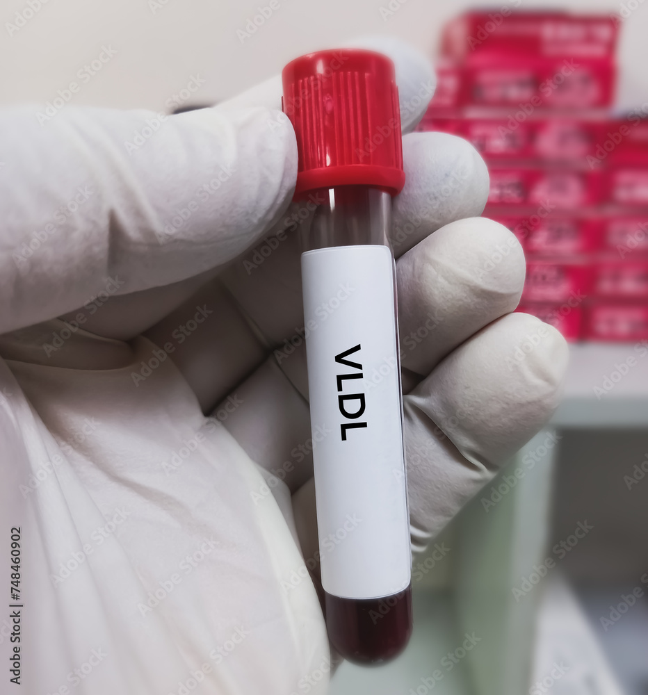 Blood sample for VLDL (Very Low Density Lipoprotein) test, helps assess ...