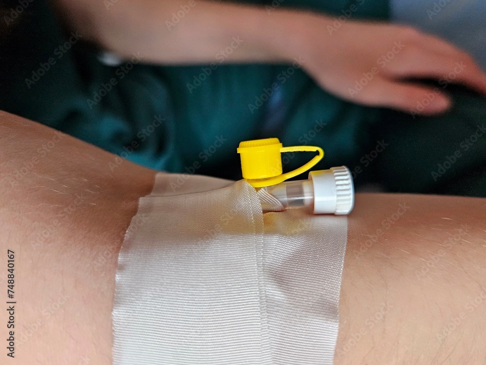 catheter for blood test. catheter in a vein in a patient. Image of a ...