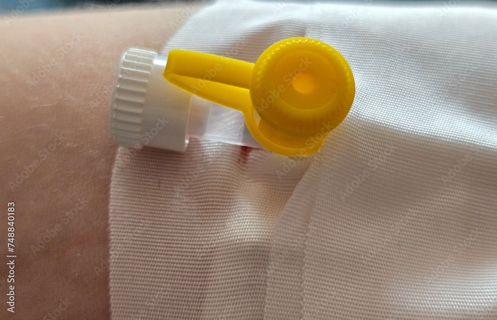 catheter for blood test. catheter in a vein in a patient. Image of a ...