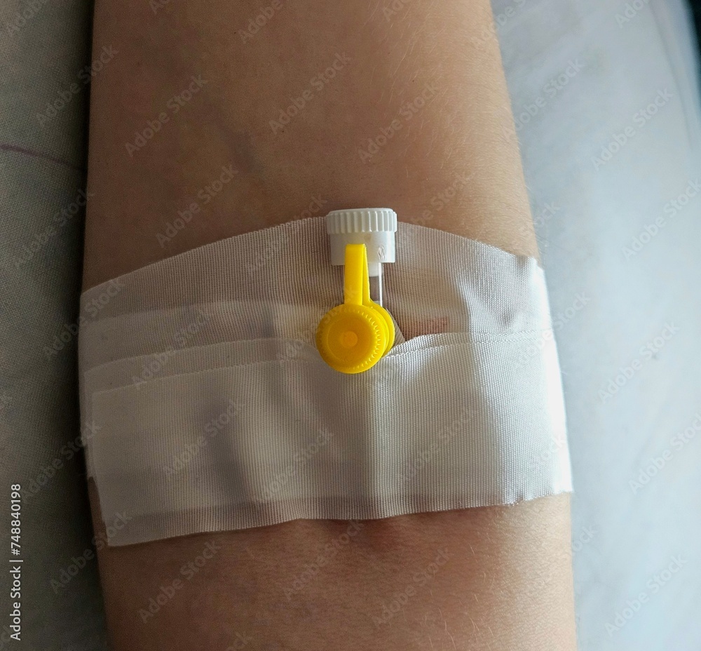 catheter for blood test. catheter in a vein in a patient. Image of a ...