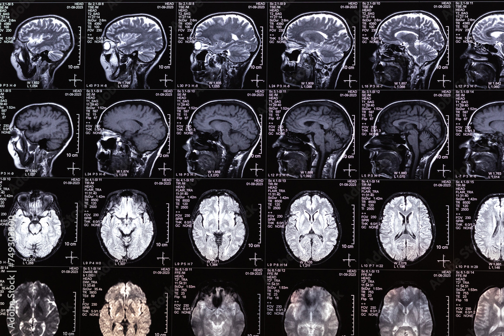 MRI, MRT, CT scan image of human brain. Medical treatmant concept ...
