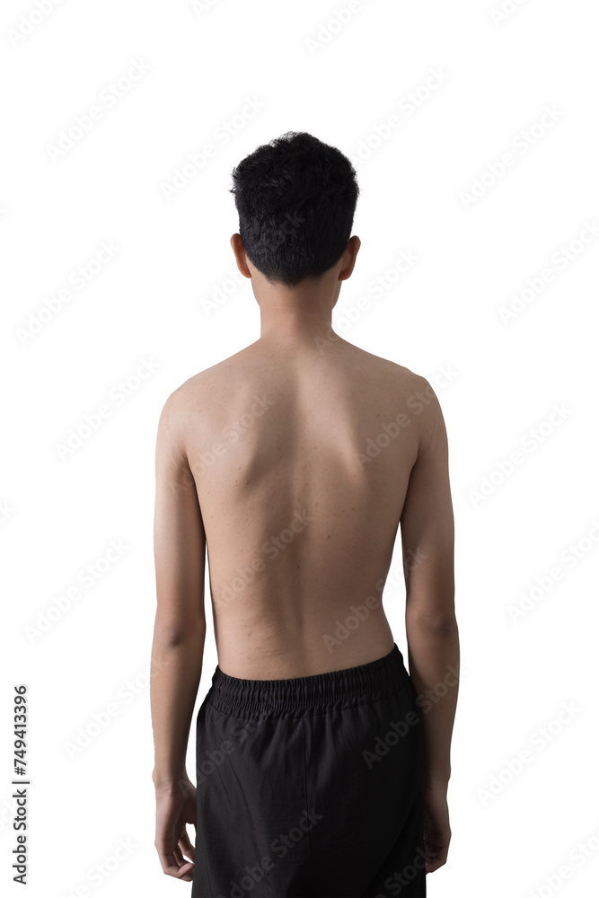 Scoliosis treatment. young man with a severe curvature of the spine ...