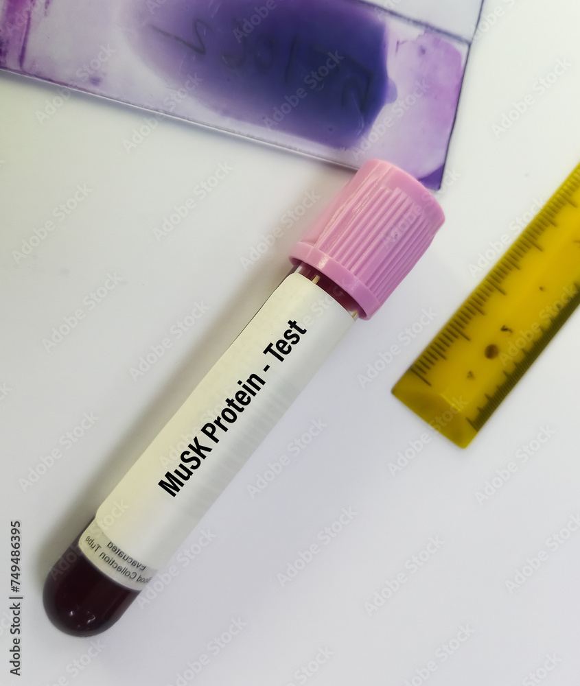Blood sample for Muscle Specific Kinase (MuSK) protein test. Myasthenia ...