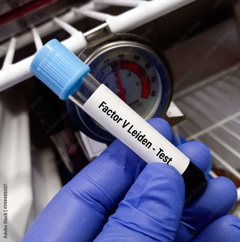 Blood sample for Factor V Leiden test, a mutation of clotting factors ...