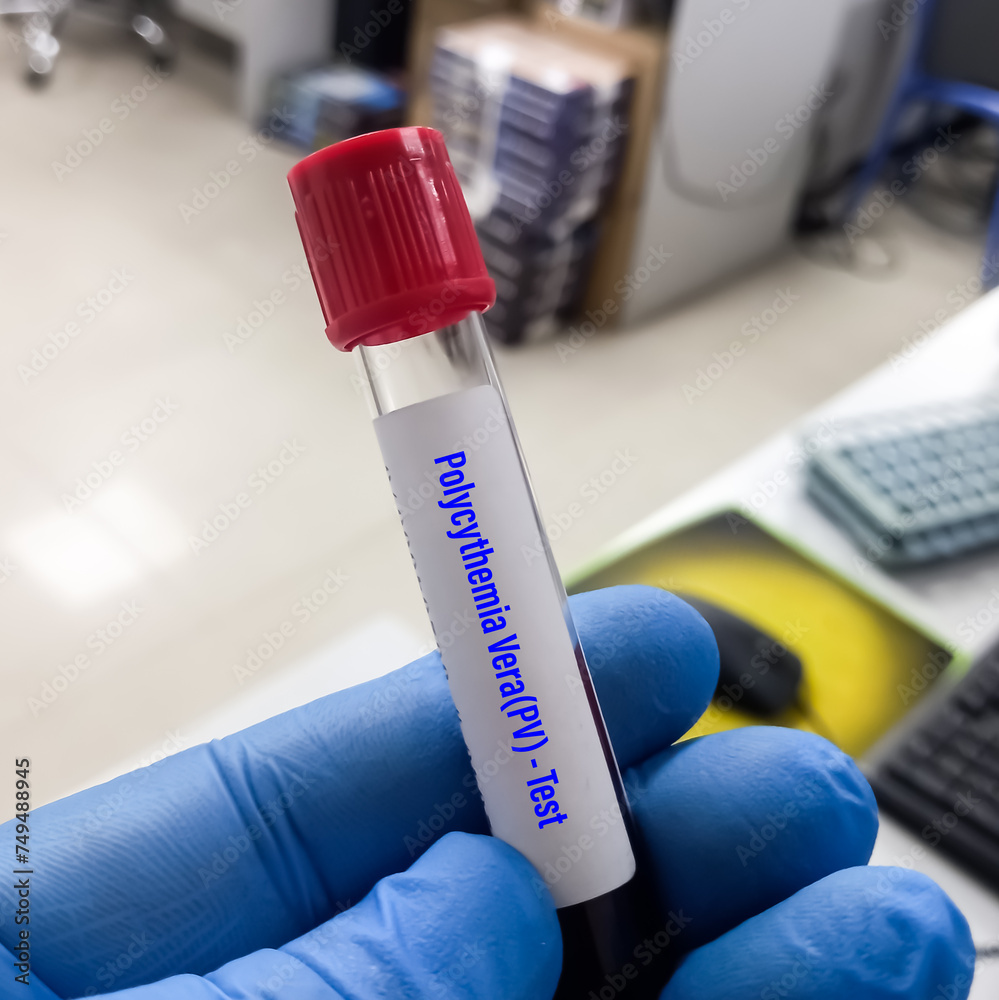 Blood sample for Polycythemia Vera (PV) test. Complete Blood Count(CBC ...