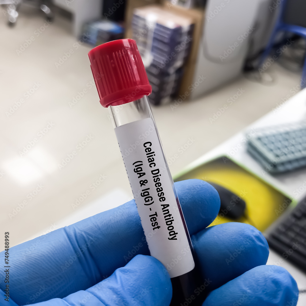 Blood sample tube for celiac disease antibodies test, help diagnose ...