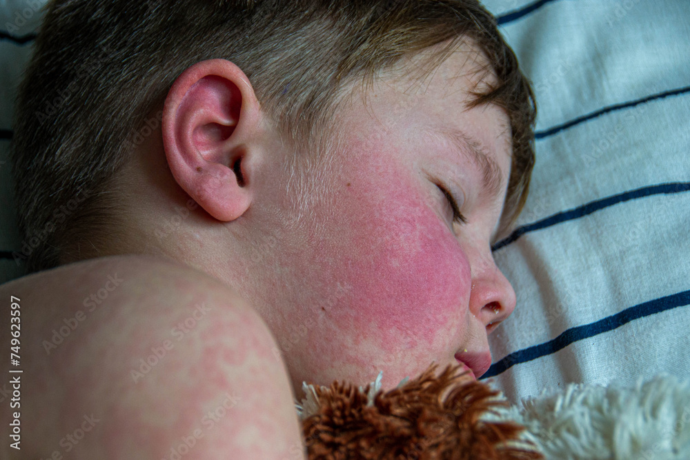Viral disease. Measles rash on the body of the child. Allergy Stock ...