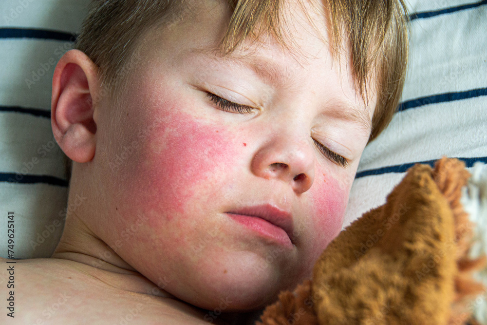 Viral disease. Measles rash on the body of the child. Allergy Stock ...