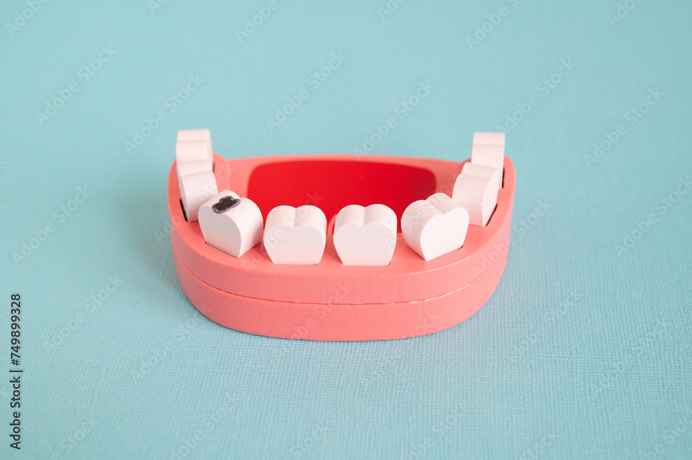 Tooth decay (cavities or caries). Model of a jaw with teeth on a ...