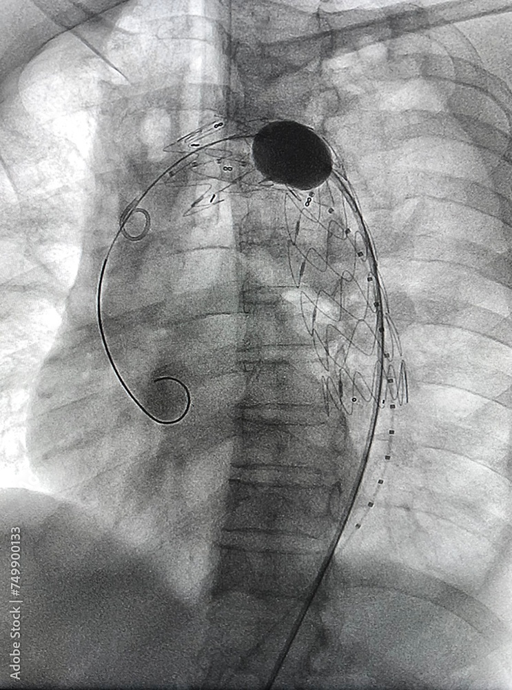 Stent graft balloon catheter was inflated after stent graft deployed at ... Stent graft balloon catheter was inflated after stent graft deployed at ...