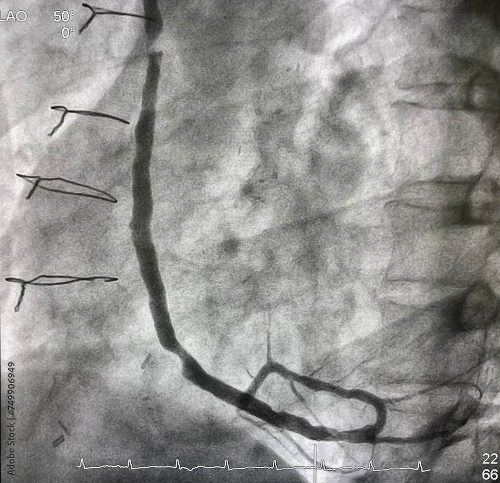 coronary angiogram showed saphenous vein graft (SVG) was stenosis after ...