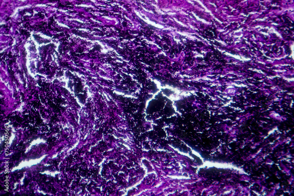 Photomicrograph of lung tissue with silicosis pathology under a ...