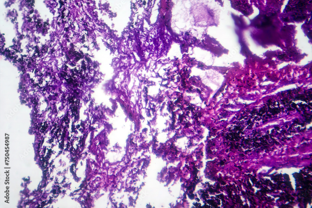 Photomicrograph of lung tissue with silicosis pathology under a ...