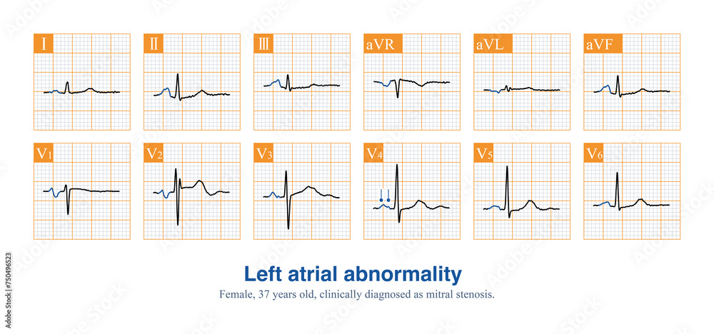 Clinically, mitral stenosis is a common heart disease affecting the ...