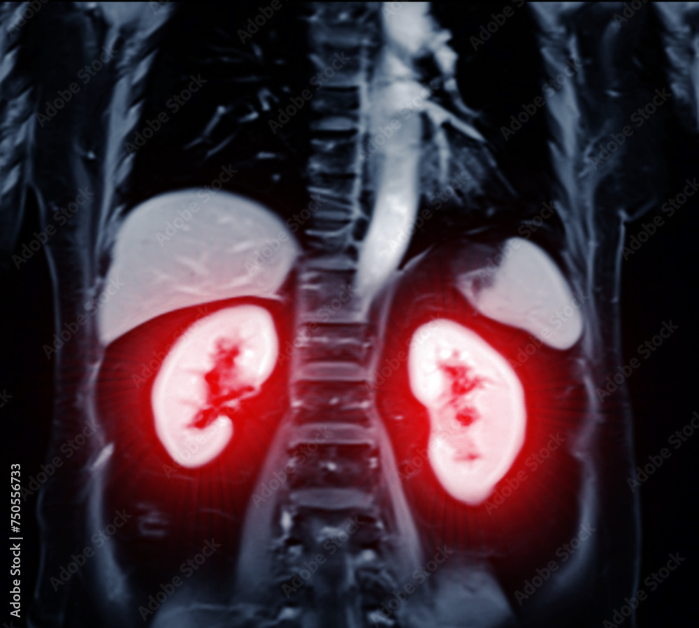 MRI of the upper abdomen coronal view is a non-invasive imaging ...