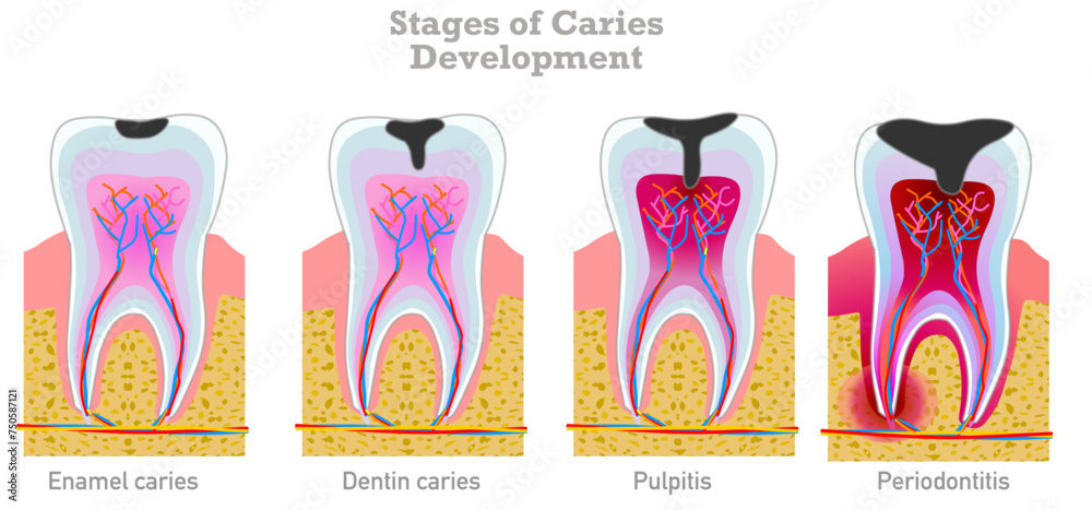 Caries stages development. Tooth decay enamel, dentin caries, pulpitis ...