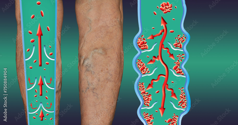 Deep Vein Thrombosis or Blood Clots. Embolus. Structure of normal and ...