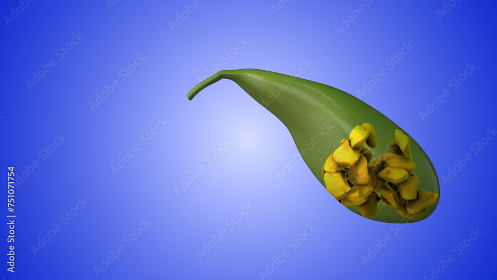 Gallstones in the gallbladder medical animation Stock Illustration ...