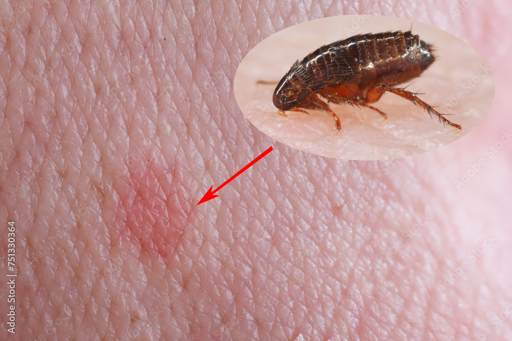 A flea biting on the skin of human hand, drinking blood. A nuisance ...