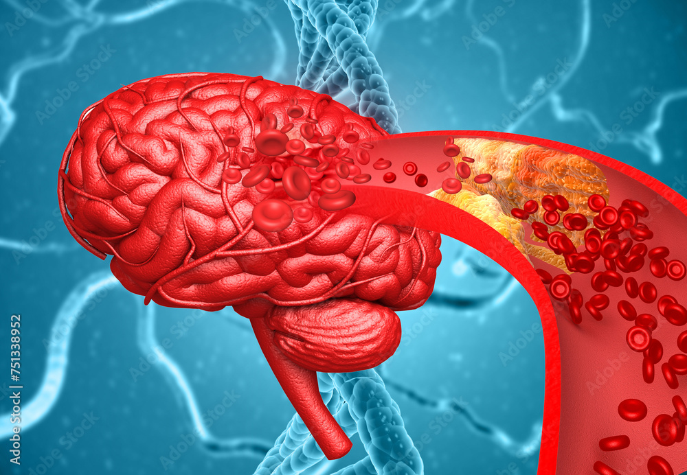 Human brain stroke concept. Clogged vein in brain. 3d illustration ...