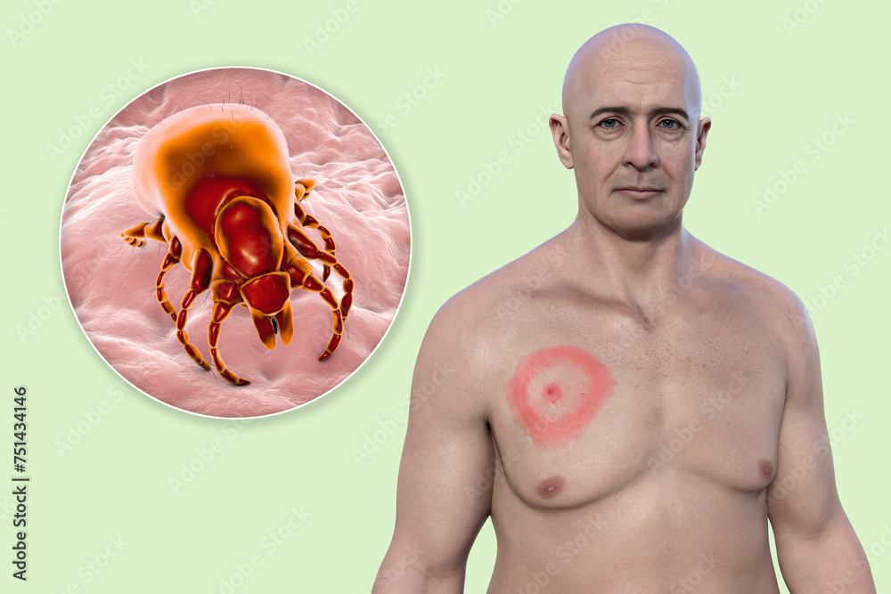 A man with erythema migrans, a characteristic rash of Lyme disease ...